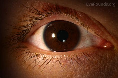 Phlyctenular Conjunctivitis