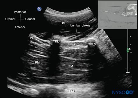 Spinal Sonography And Applications Of Ultrasound For Central Neuraxial