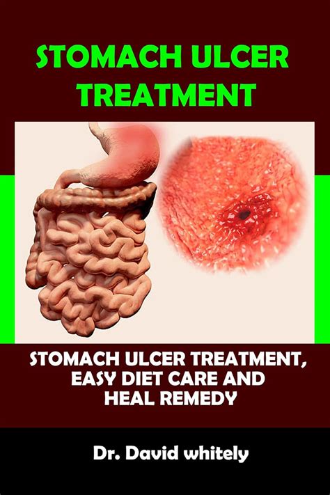 Stomach Ulcer Treatment Stomach Ulcer Treatment Easy Diet Care And