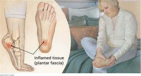 Plantar Fasciitis Part Harding Podiatry