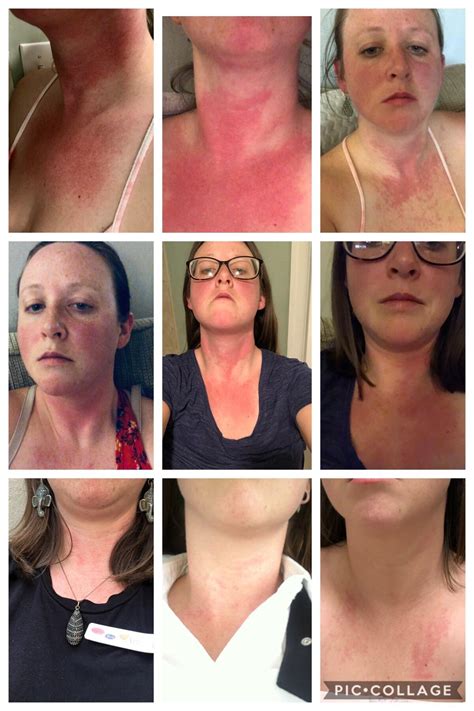 Rosacea On Neck The Best Way To Manage And Clear Rosacea Amperna®