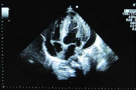 2d Echo Apical Four Chamber Revealing Severe Concentric Left Download Scientific Diagram