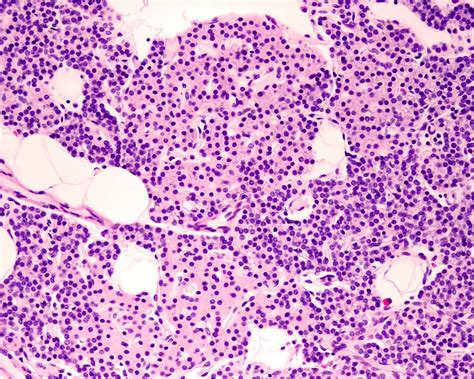 Diagnosing Neuroblastoma