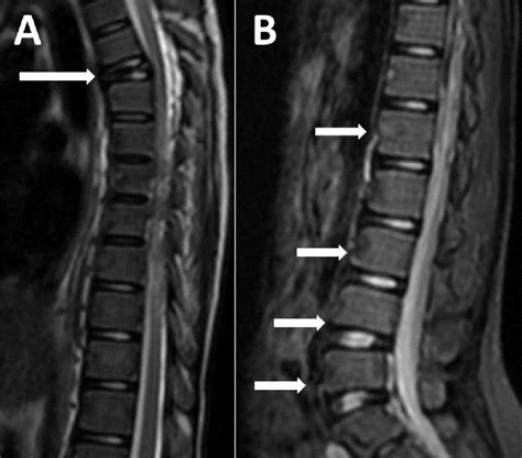 Pathological Fracture Spine