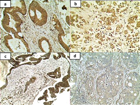 Sections Of Crc Immunostained By β Catenin A Case Of Well Moderately Download Scientific