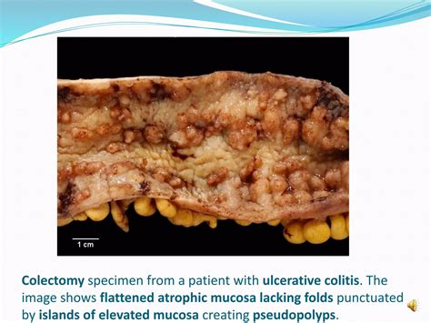 Ibd Ulcerative Colitis And Crohns Disease Pptx