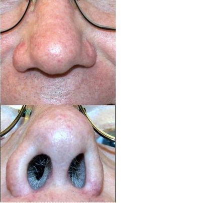 How Can Asymmetrical Nostrils Be Corrected Doctor Answers Tips