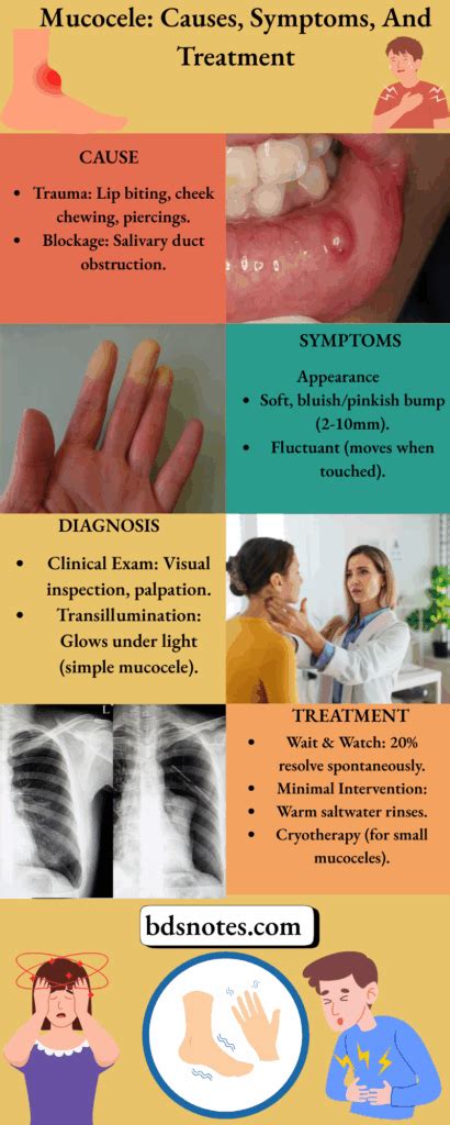 Mucocele Causes Symptoms And Treatment Bds Notes