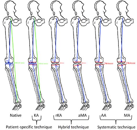 Different Techniques For Aligning Total Knee Arthroplasty Implants On A