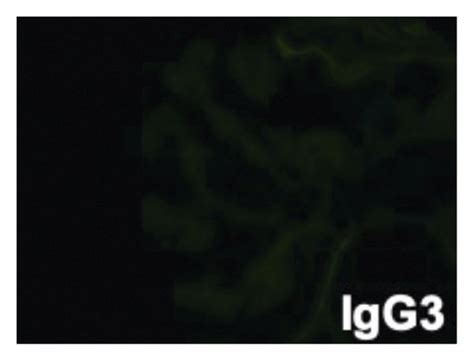 Renal Biopsy Showing Deposition Of Immunoglobulin G Igg And