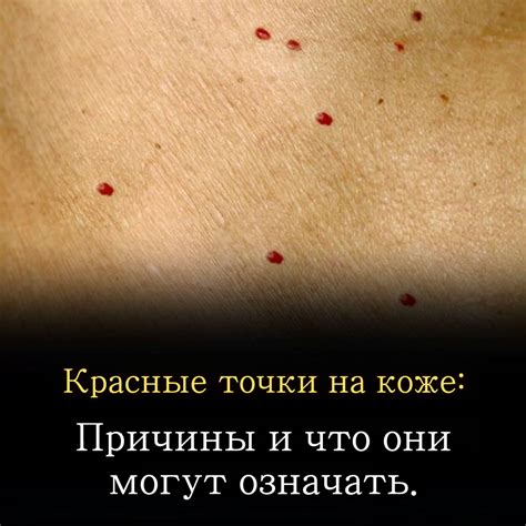 Самое Если вы заметите эти красные точки на своей коже вам лучше знать что они означают 😮