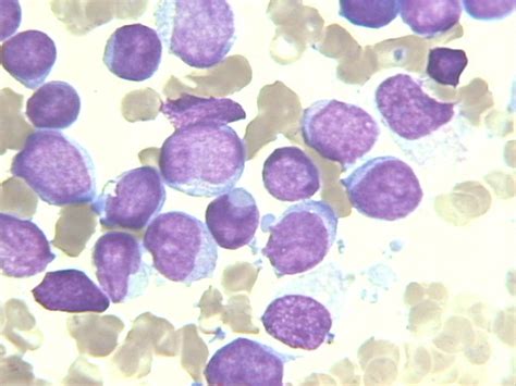Morphology Of Acute Myeloid Leukemia With Cuplike Blasts Download Scientific Diagram