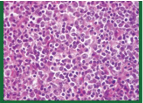 Dlbcl With Reactive Appearing Lymphocytes In The Background A C Download Scientific Diagram