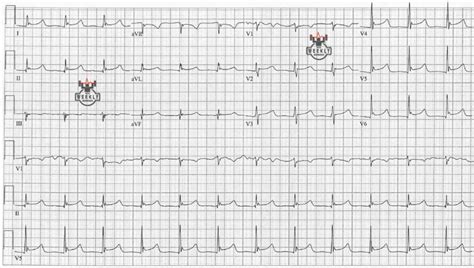 Early Repolarization Ecg