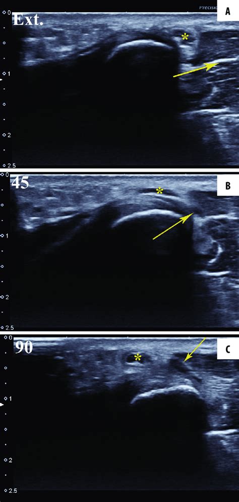 Dislocation Of The Ulnar Nerve And An Additional Muscle Band Download Scientific Diagram