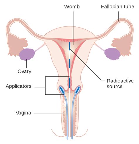 Radiotherapy For Cervical Cancer Irish Cancer Society