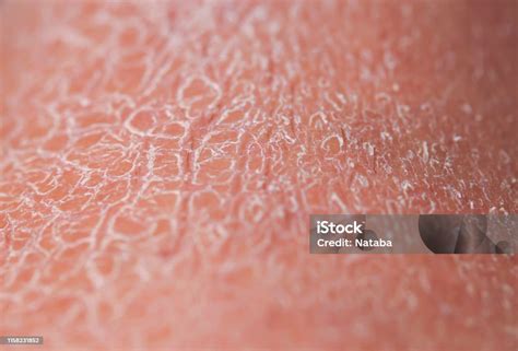 태양 노출 후 크고 작은 균열과 죽은 벗겨진 비늘로 덮인 건조한 건강에 해로운 피부 질감의 배경 손에 대한 스톡 사진 및 기타