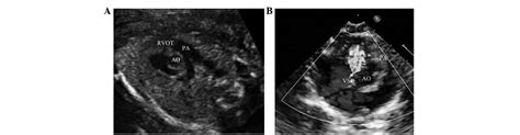 Application Of Spatio Temporal Image Correlation Technology In The Diagnosis Of Fetal Cardiac