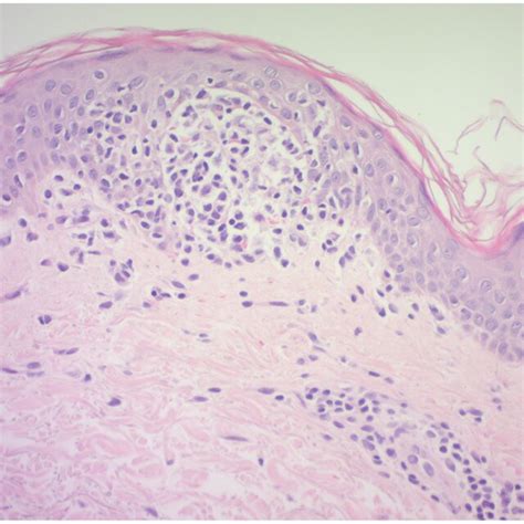 A Upper Dermal Infiltrate Of Lymphocytes Histiocytes And Some Red Download Scientific