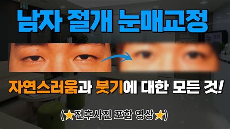 모티브 성형외과 남자 절개눈매교정 자연스러움과 붓기 총 정리 편 전후사진 함께 봐요 남자눈성형남자눈매교정남자쌍꺼풀수술남자눈재수술남자눈매교정전후