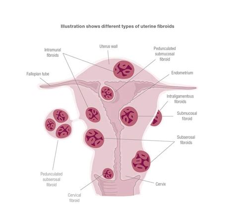 Fibroids Type