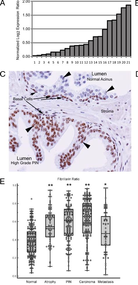 Figure 5 From Tumorigenesis And Neoplastic Progression Alterations In Nucleolar Structure And