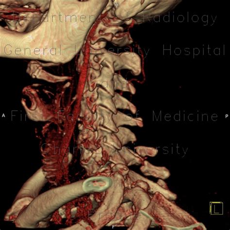 Radiology Case Separation Of Spinous Process Of C6 And C7 Congenital
