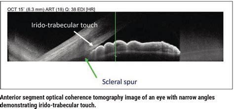 Cataract Surgery In Eyes With Angle Closure