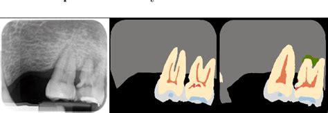 Figure 1 From Multi Class Semantic Segmentation Of Tooth Pathologies