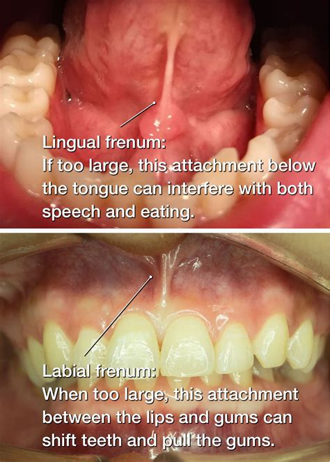Frenulum Between Front Teeth Captions Prince