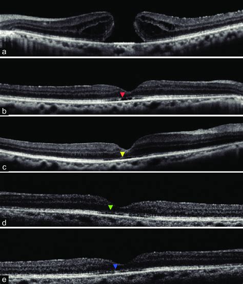 Oct Scans Preoperatively Figure 1a And At 1 Month Figure 1b 3
