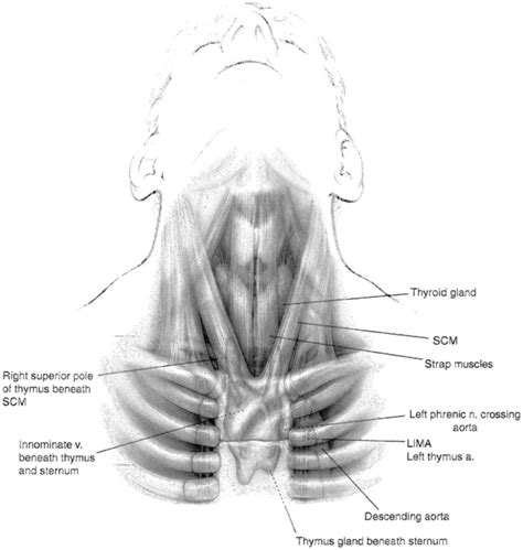 Transcervical Thymectomy Operative Techniques In Thoracic And Cardiovascular Surgery