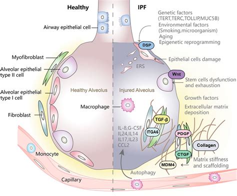 Fibrose Pulmonar Idiopatica Idiopathic Pulmonary Fibrosis Pathogenesis