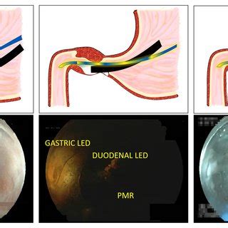 Animation And Endoscopic Image Of G Poem Procedure Guided And Confirmed