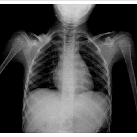 A Plain Frontal Chest Radiograph Demonstrating The Right Mid Clavicular Download Scientific