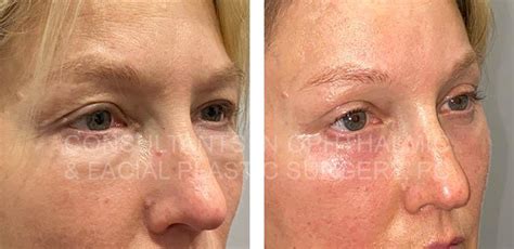 Endoscopic Forehead And Brow Lift Transconjunctival Excision Herniated Orbital Fat With Co2