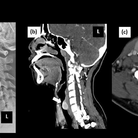 Pdf A Rare Case Of Subglottic Ectopic Thyroid Tissue Causing Upper