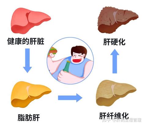 早期肝硬化，有恢复正常可能吗？ 知乎