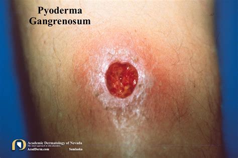 Pyoderma Gangrenosum Its Not An Infection Academic Dermatology Of Nevada