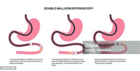 Double Balloon Enteroscopy Stock Illustration Download Image Now