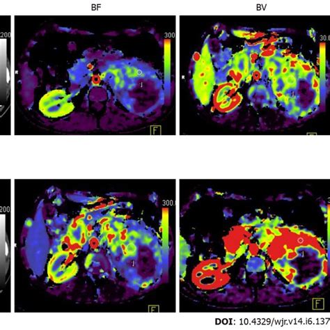 Pre Treatment A And Post Treatment B Computed Tomography Perfusion Download Scientific