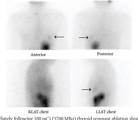 Figure 1 From Focal Bronchiectasis Causing Abnormal Pulmonary