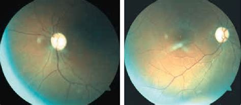 Funduscopy Of Patient 2 Showing Bilateral Optic Atrophy And Normal Download Scientific Diagram