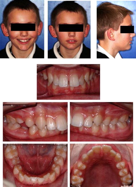 Pre Treatment Clinical Photographs Note That The Molar Relationship Is Download Scientific
