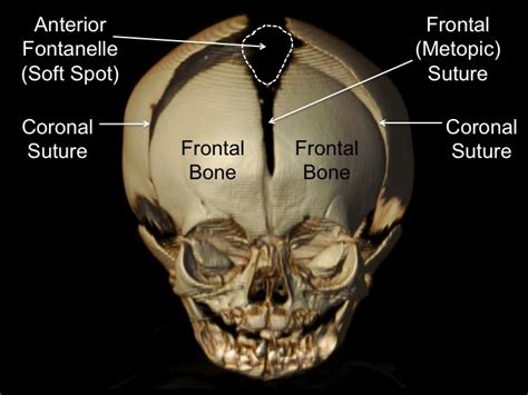 Isolated Craniosynostosis — Dallas Pediatric Plastic Surgeon Craniofacial Surgeon Cleft Lip