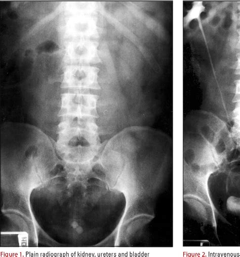 Figure 2 From Blind Ending Ureteral Duplication With Calculi Semantic Scholar