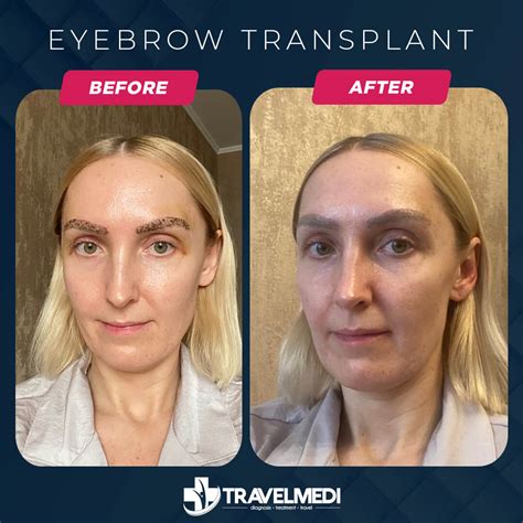 Eyebrow Transplant Prices Before After 2026