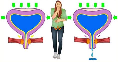 Недержание мочи у женщин после 60 лет — способы лечения причины применение пессария от