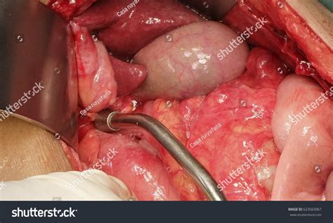 Perforated Appendix