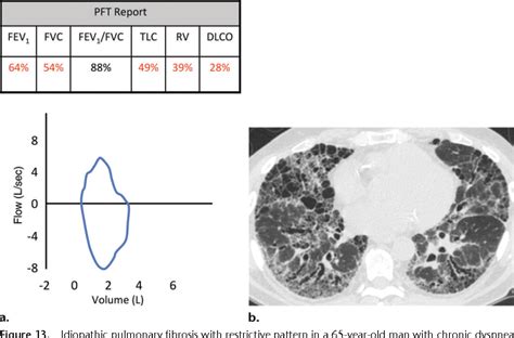 Figure 13 From Pulmonary Function Tests For The Radiologist Semantic Scholar
